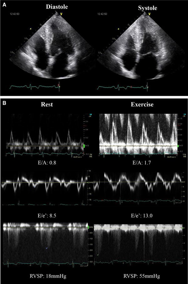 Exercise stress echocardiography in hypertrophic cardiomyopathy ...