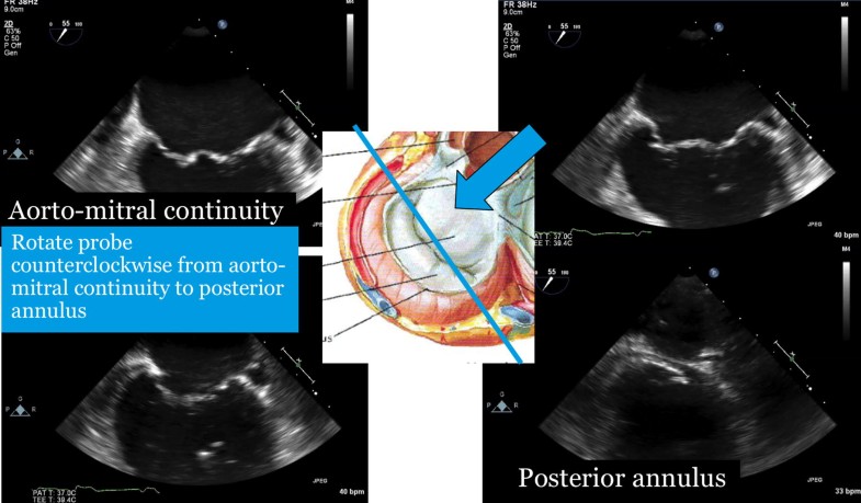 Echocardiographic guidance for transcatheter mitral valve repair using ...