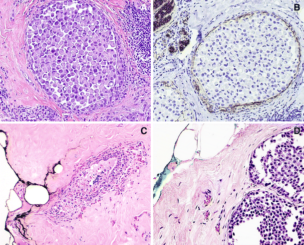 The Diagnosis of Pleomorphic Lobular Carcinoma In Situ Warrants ...