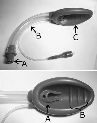 Lighted stylet-guided intubation via the intubating laryngeal airway in ...
