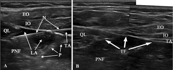 Transversalis fascia plane block, a novel ultrasound-guided abdominal ...