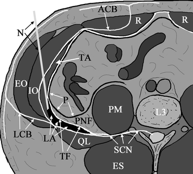 Transversalis fascia plane block, a novel ultrasound-guided abdominal ...