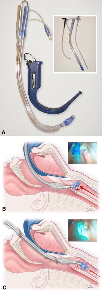 Sequential rotation to insert a left double-lumen endotracheal tube ...