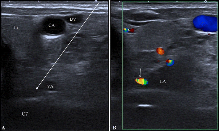 Ultrasound-guided bilateral stellate ganglion blockade to treat digital ...