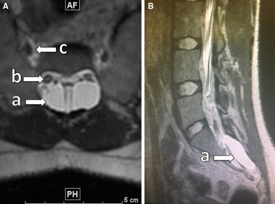 Epidural blood patch treatment for headache caused by a ruptured Tarlov ...
