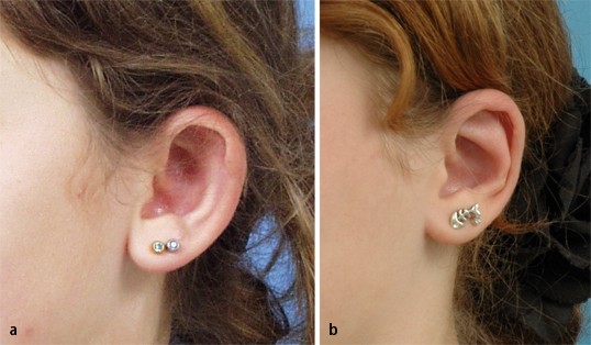 Plastische Chirurgie der Tassenohrdeformität | SpringerLink