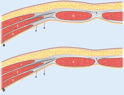 Anatomie der Bauchdecke | SpringerLink