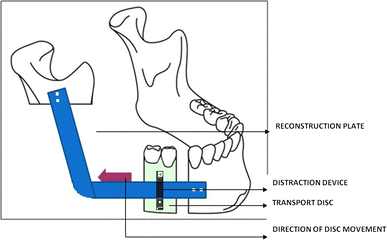 Transport Distraction Osteogenesis for Maxillomandibular Reconstruction ...