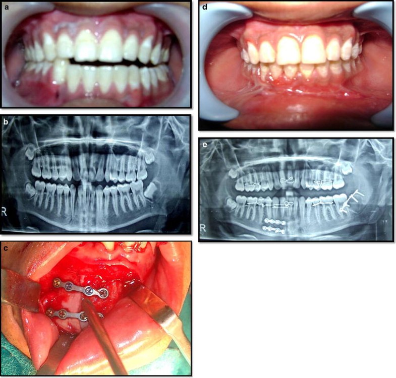 A Comparative Evaluation of Fixation Techniques in Anterior Mandibular ...
