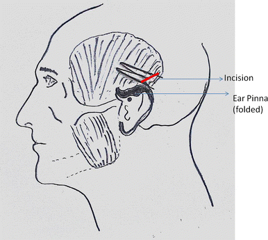 Posterior Auricular Approach for Decompression and Drainage of ...