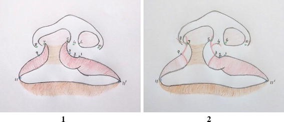 Comparison of Outcome of Modified Millard’s Incision and Delaire’s ...