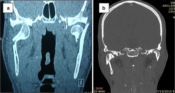 Efficacy of the Retroparotid Trans-Masseteric Approach via ...