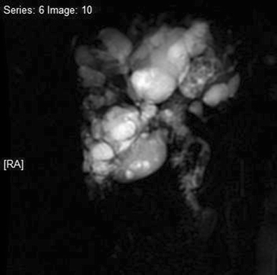 Caroli’s disease | SpringerLink