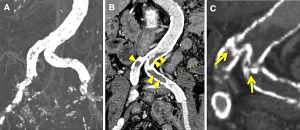 “Staged” kissing stent placement under computed tomographic angiography ...