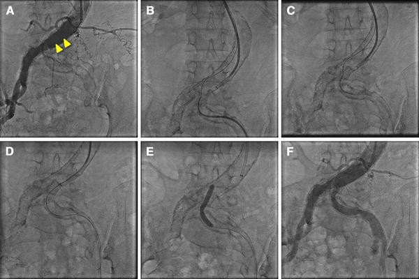 “Staged” kissing stent placement under computed tomographic angiography ...