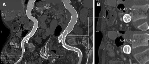 “Staged” kissing stent placement under computed tomographic angiography ...