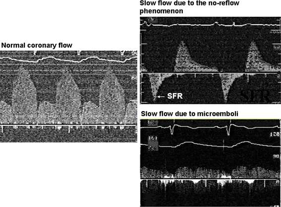 The no-reflow phenomenon associated with percutaneous coronary intervention: its mechanisms and ...