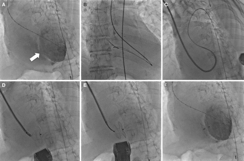 Percutaneous closure of post-infarction ventricular septal defect using ...