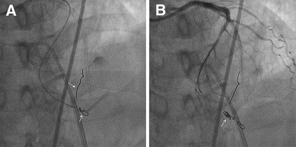 Sealing of a dual feeding coronary artery perforation with homemade ...