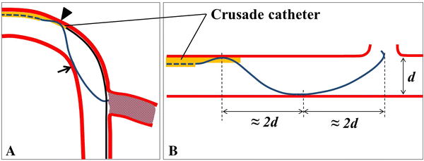 Reverse bent wiring with Crusade catheter can be a useful technique for ...