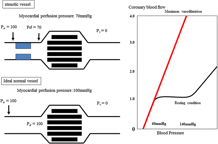 FFR and iFR guided percutaneous coronary intervention | SpringerLink