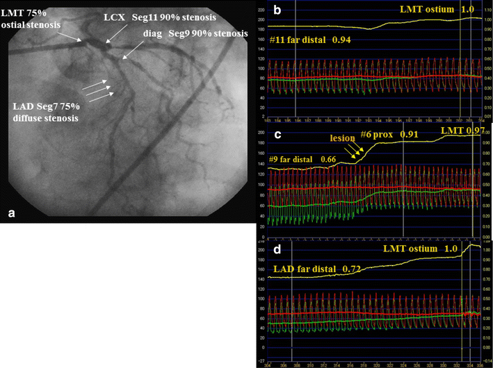 FFR and iFR guided percutaneous coronary intervention | SpringerLink
