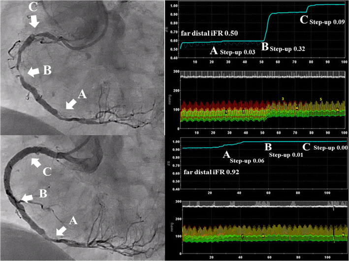 FFR and iFR guided percutaneous coronary intervention | SpringerLink