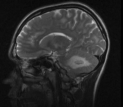“Chasing the Dragon”—Heroin-Associated Spongiform Leukoencephalopathy ...