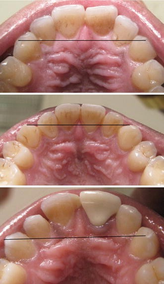 The Incisive Papilla: A Significant Landmark in Prosthodontics ...