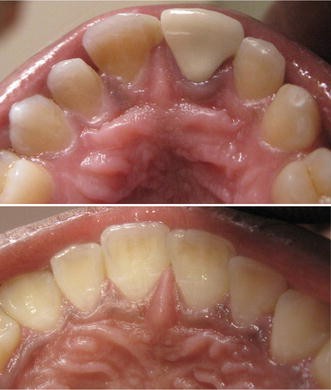 The Incisive Papilla: A Significant Landmark in Prosthodontics ...