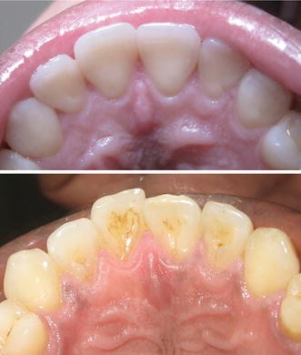 The Incisive Papilla: A Significant Landmark in Prosthodontics ...