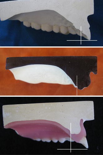 The Incisive Papilla: A Significant Landmark in Prosthodontics ...