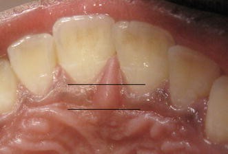 The Incisive Papilla: A Significant Landmark in Prosthodontics ...