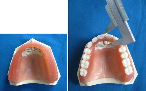 The Incisive Papilla: A Significant Landmark in Prosthodontics ...