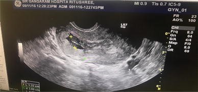 Interstitial and Cornual Ectopic Pregnancy: Conservative Surgical and ...