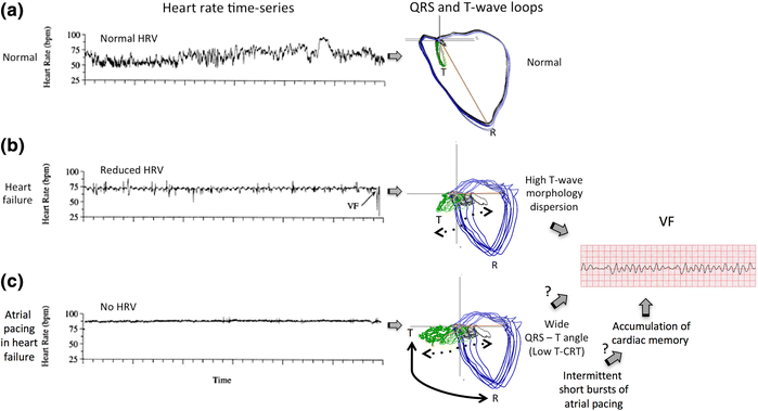 Effect of Loss of Heart Rate Variability on T-Wave Heterogeneity and QT ...