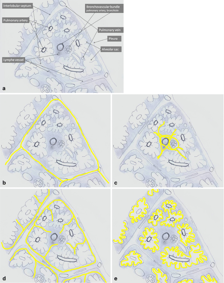 The crazy-paving pattern: a radiological-pathological correlation ...