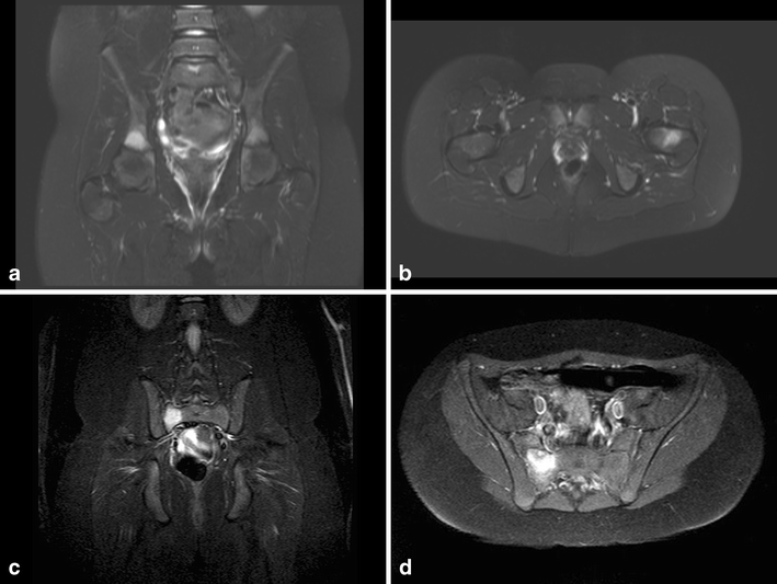 Childhood osteomyelitis: imaging characteristics | Insights into ...
