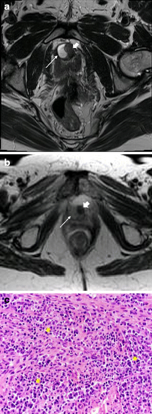 Magnetic resonance imaging of solid urethral and peri-urethral lesions ...