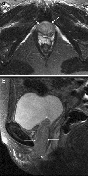 Magnetic resonance imaging of solid urethral and peri-urethral lesions ...