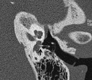 Imaging in otosclerosis: A pictorial review | SpringerLink