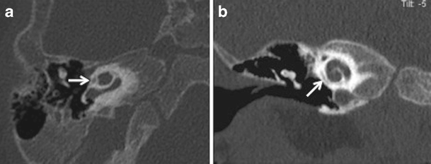 Imaging in otosclerosis: A pictorial review | Insights into Imaging ...
