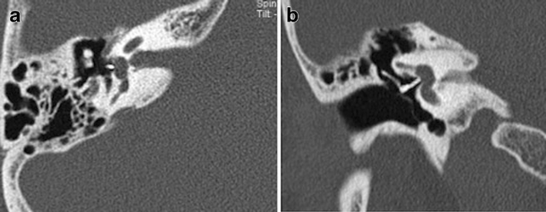 Imaging in otosclerosis: A pictorial review | Insights into Imaging ...