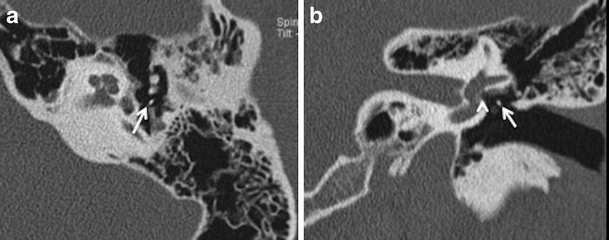 Imaging in otosclerosis: A pictorial review | SpringerLink