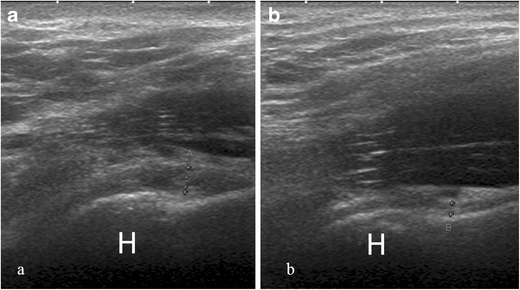 Multi-modal imaging of adhesive capsulitis of the shoulder | Insights ...