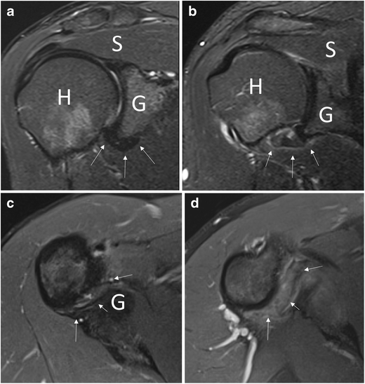 Multi-modal imaging of adhesive capsulitis of the shoulder | SpringerLink