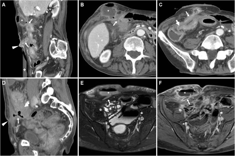 Enterocutaneous fistulas: a primer for radiologists with emphasis on CT ...