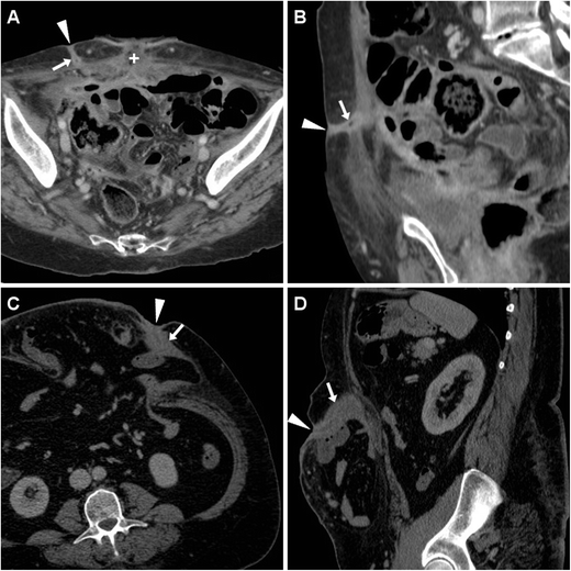 Enterocutaneous fistulas: a primer for radiologists with emphasis on CT ...