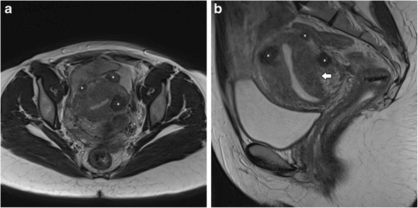 MRI for adenomyosis: a pictorial review | Insights into Imaging | Full Text