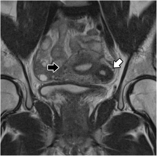 MRI for adenomyosis: a pictorial review | SpringerLink